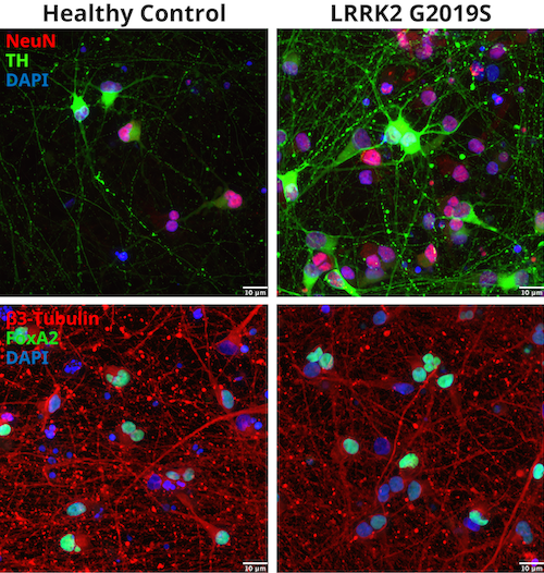 Characterizing the Autophagic-Lysosomal Pathway in Parkinson’s