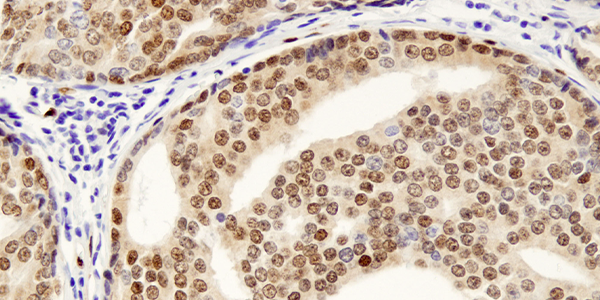 Emerging Therapeutic Approaches for Prostate Cancer